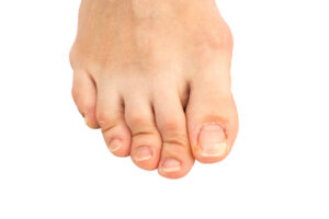 Fixing a Cracked, Broken, or Split Toenail | Red Mountain Footcare