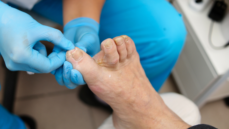 What Should I Do About Ingrown Toenails | Red Mountain Footcare