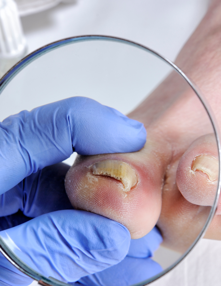 What are the White Patches on my Toenails? | Red Mountain Footcare