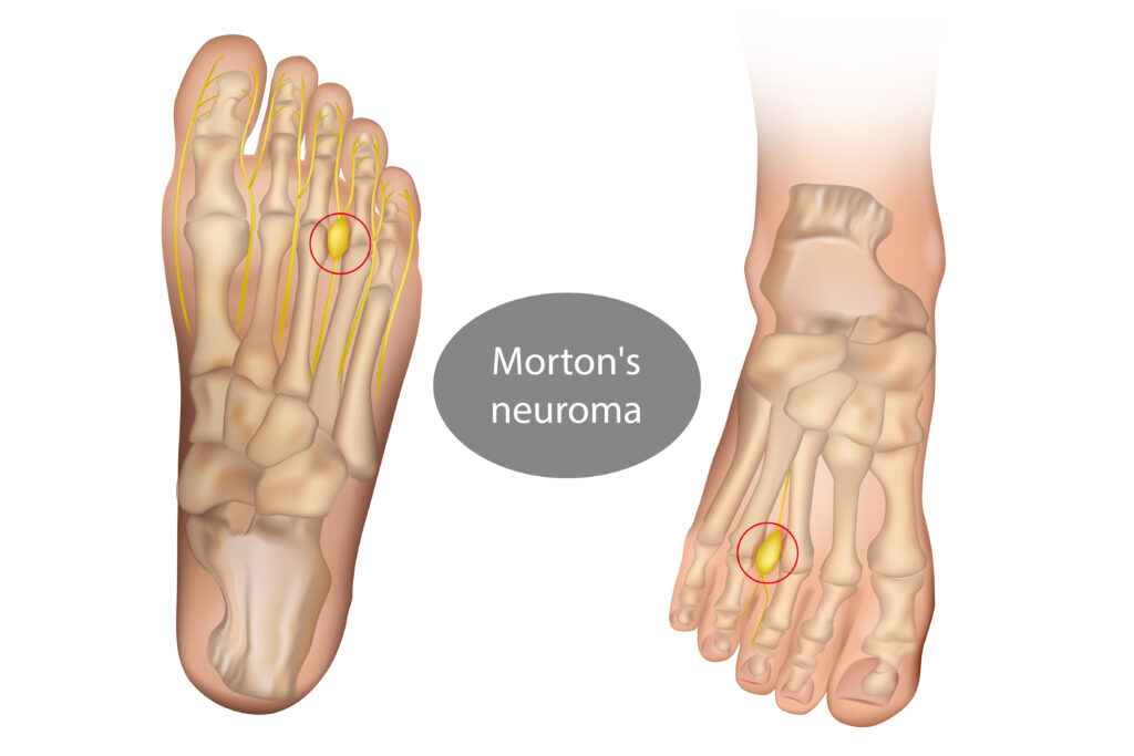 Understanding and Preventing Morton's Neuroma | Red Mountain Footcare