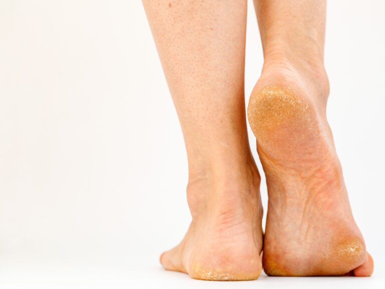 Corns and Calluses: What's the Difference? | Arizona Red Mountain Footcare