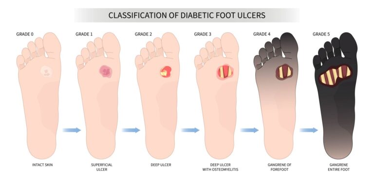 Diabetic Foot Complications: Prevention & Care in Mesa, AZ